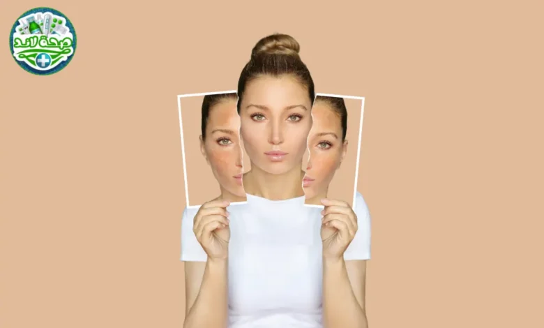 الكلف (Melasma): الأسباب، الأنواع، التشخيص، وطرق العلاج الطبية